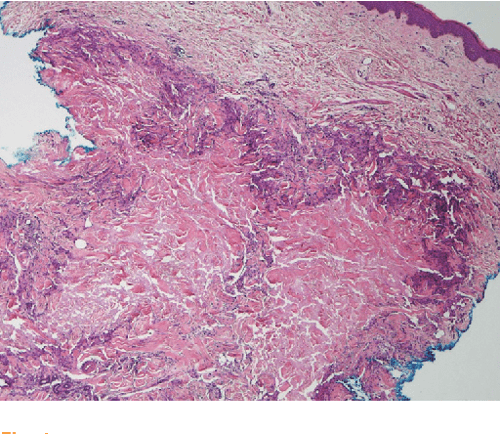 Figure 1 from Reconstruction of the Alar-Facial Groove Using a ...