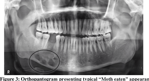 SURGICAL MANAGEMENT OF CHRONIC SUPPURATIVE OSTEOMYELITIS OF MANDIBLE IN ...