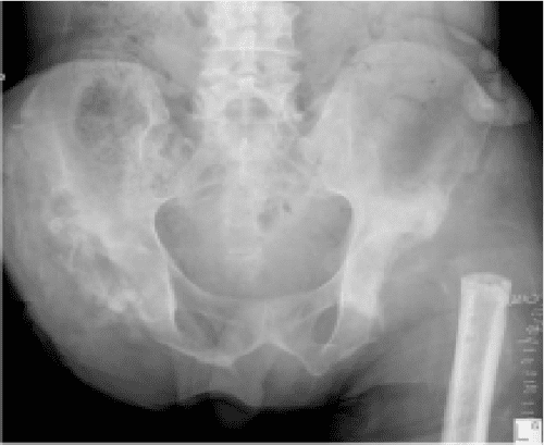 Figure 2 from Bilateral hip disarticulation in paraplegics | Semantic ...