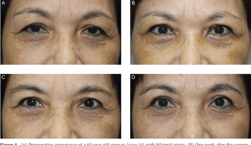 Figure 4 from Modified Levator Muscle Resection Using Putterman Muller ...