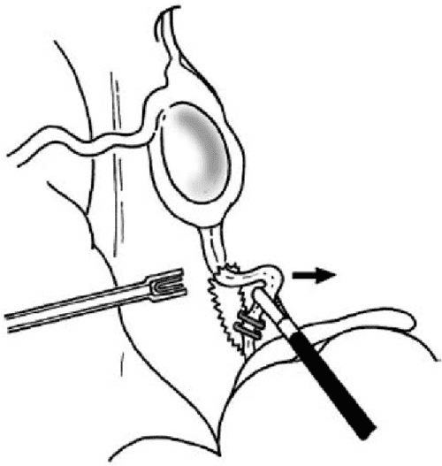 Laparoscopic Fowler-Stephens orchiopexy: the Westchester Medical Center ...
