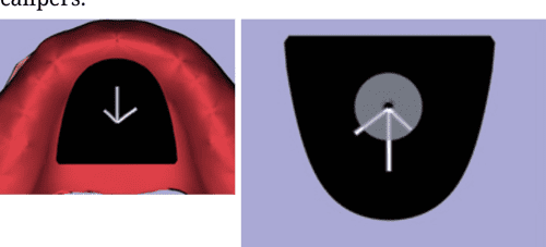 Using intraoral Gothic arch tracing to balance full dentures and ...