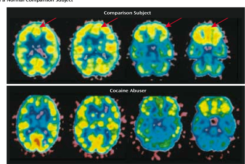 Figure 3 from Drug addiction and its underlying neurobiological basis ...