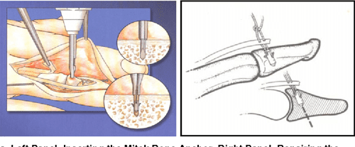 Repair of the central slip of extensor tendon and the open mallet using ...