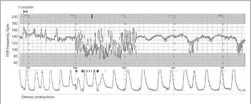 Figure 1 from Saltatory Pattern of Fetal Heart Rate during Labor Is a ...