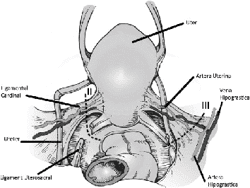 [PDF] Types of radical hysterectomies | Semantic Scholar
