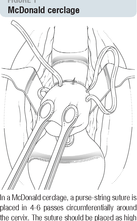 [PDF] Transvaginal cervical cerclage: evidence for perioperative ...