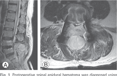 Figure 1 from Postoperative Spinal Epidural Hematoma: The Danger Caused ...