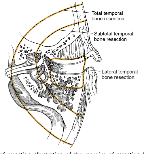Squamous cell carcinoma of the temporal bone. | Semantic Scholar