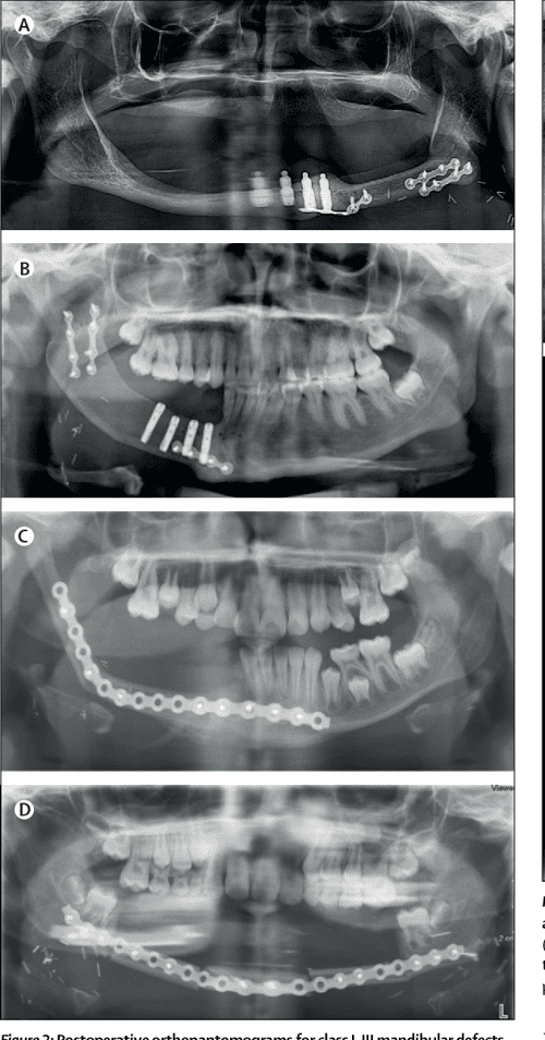 Figure 2 from A new classification for mandibular defects after ...