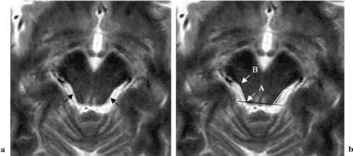 Morning glory sign: a particular MR finding in progressive supranuclear ...