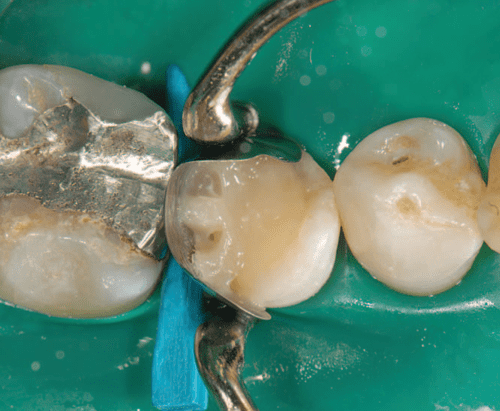 Figure 9 from Proximal box elevation with resin composite and the dogma ...