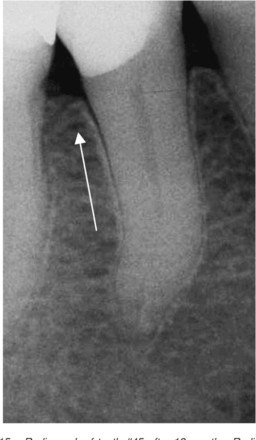 Figure 1 from Proximal box elevation with resin composite and the dogma ...