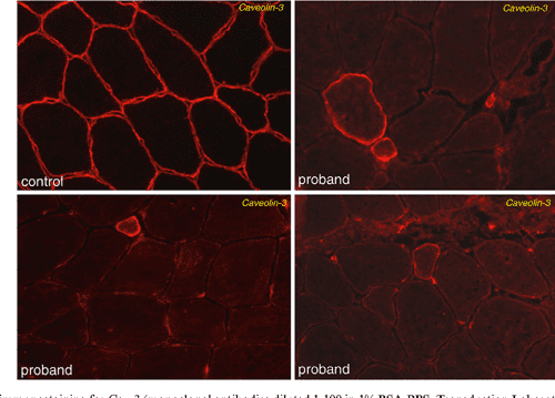 Figure 1 from Rippling muscle disease and facioscapulohumeral dystrophy ...