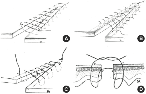 Figure 2 from Modified Continuous Mucosal Connell Suture for the ...