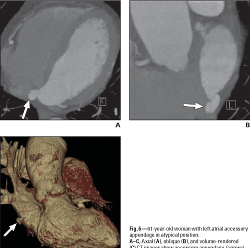 Cardiac CT assessment of left atrial accessory appendages and ...