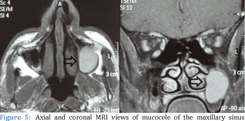 Figure 4 from Pathology Differential diagnosis of antral pseudocyst ...