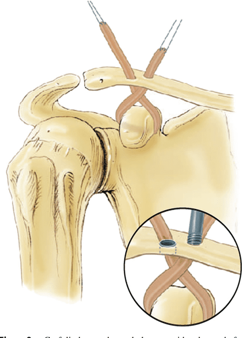Figure 5 from The anatomic coracoclavicular ligament reconstruction ...