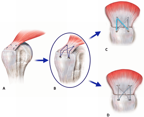 Figure 3 from Arthroscopic Single-Row Versus Double-Row Repair for Full ...