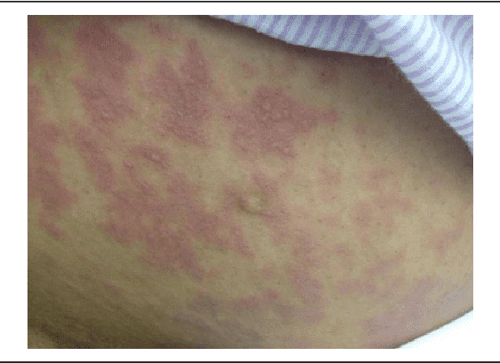 Pediatric Stevens-Johnson Syndrome/Toxic Epidermal Necrolysis Halted by ...