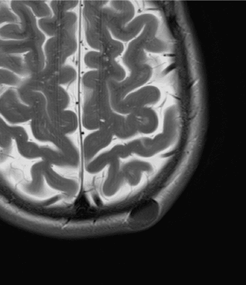 Scalp Lesions Incidentally Discovered On The Mri Scans Of The Head Prevalence Type And Meaning