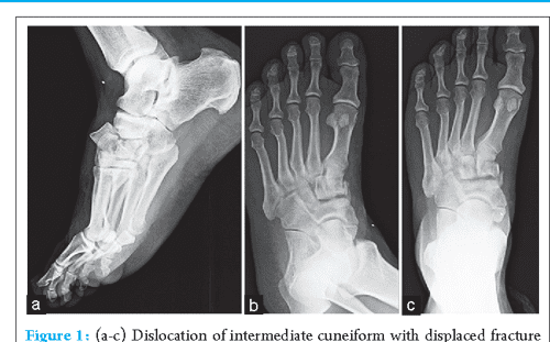 Figure 1 from Dislocation Intermediate Cuneiform with Fracture Medial ...