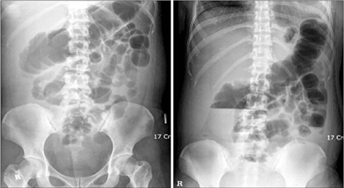 [PDF] A Case of Transverse Colon Perforation after Colonoscopy in a ...