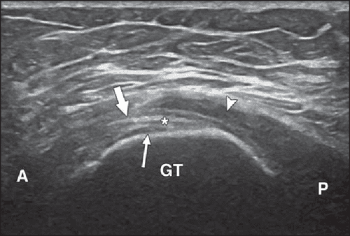 Figure 2—31 from Ultrasound-guided corticosteroid injections for ...