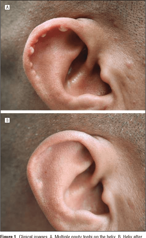 Curettage as an acceptable treatment for gouty tophi on the ear ...