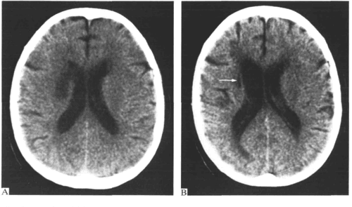 Figure 2 from The stroke syndrome of striatocapsular infarction ...