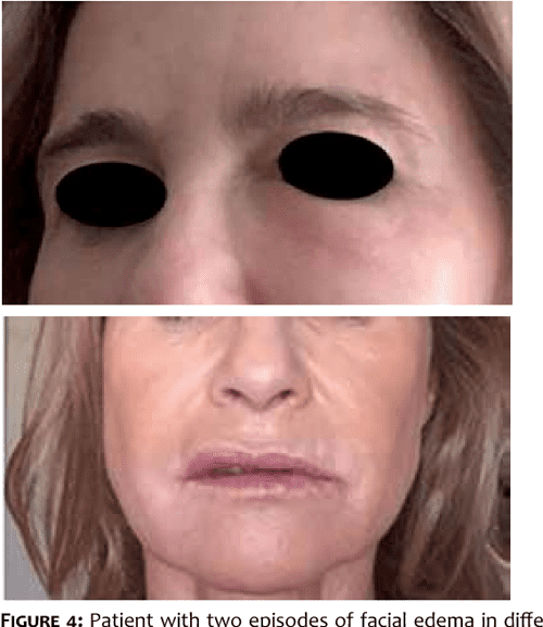[pdf] Persistent Intermitent Delayed Swelling Pids Late Adverse