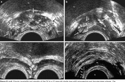 [PDF] Transrectal US-guided seminal vesicle aspiration in the diagnosis ...