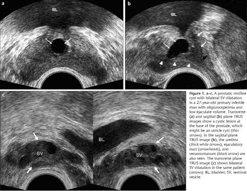 [PDF] Transrectal US-guided seminal vesicle aspiration in the diagnosis ...