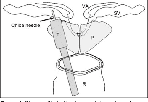 [PDF] Transrectal US-guided seminal vesicle aspiration in the diagnosis ...