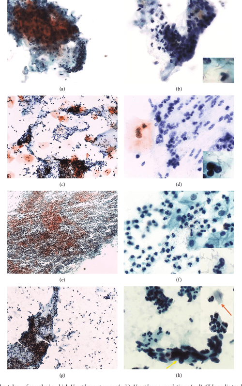 Figure 1 from Cervical Cytology of Samples with Ureaplasma urealyticum ...