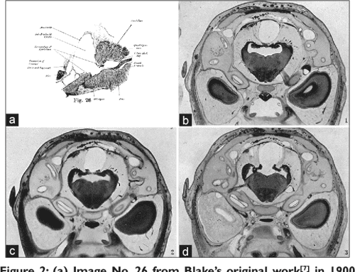 [PDF] Blake's pouch cyst | Semantic Scholar