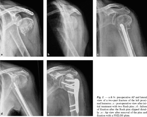 [PDF] Outcome of proximal humerus fractures treated by PHILOS plate internal fixation ...